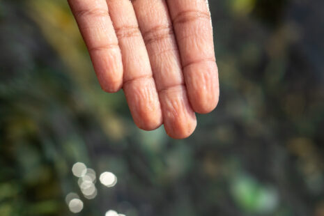 Pruney Fingers: What It Means and When To Be Concerned - HealthSurgeon ...