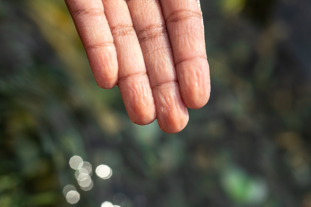 Pruney Fingers: What It Means and When To Be Concerned - HealthSurgeon ...