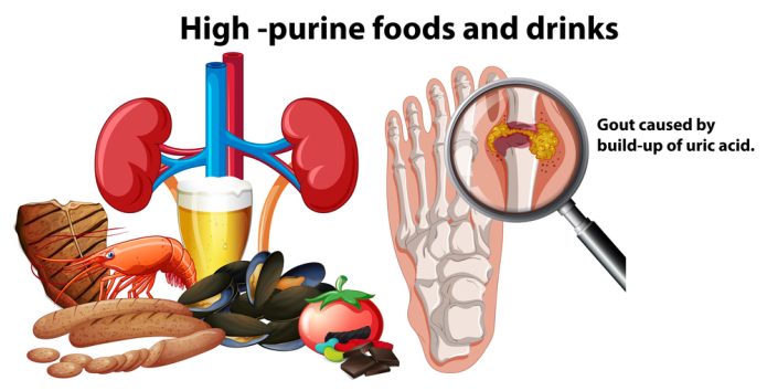 Gout: Causes, Symptoms, Treatment, and the Best Diet to Prevent Flare ...